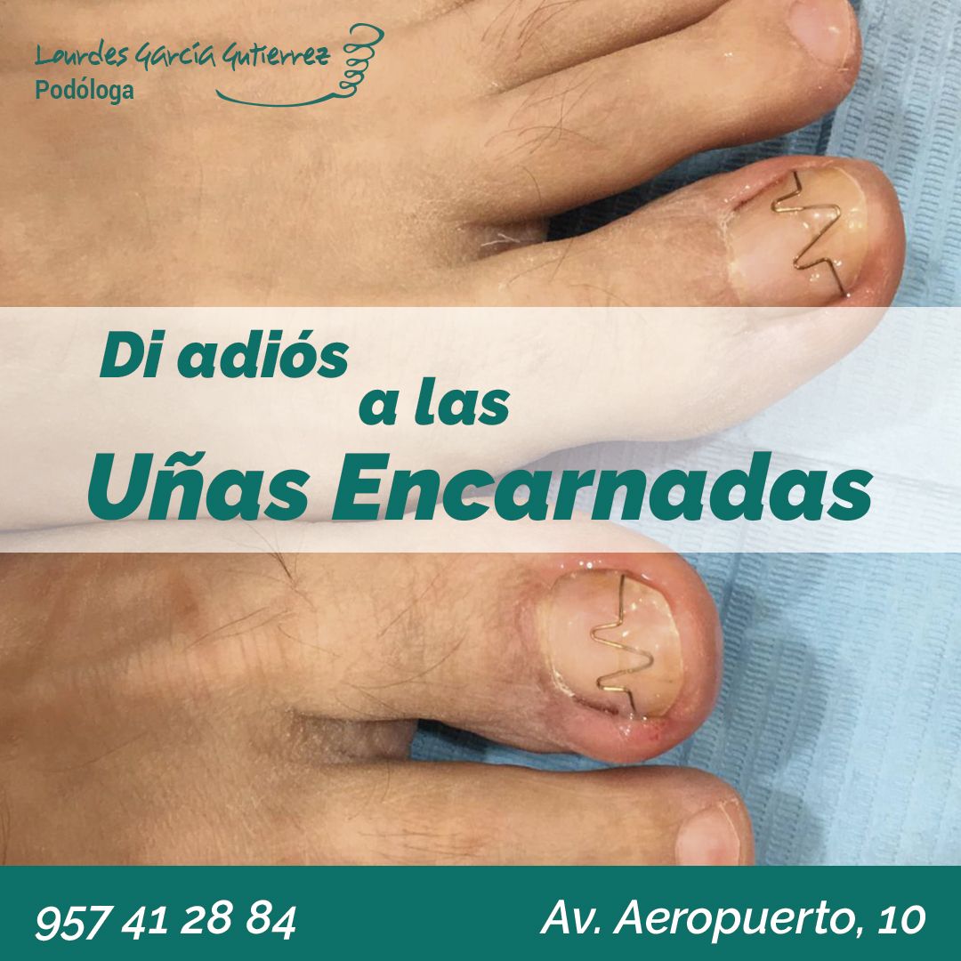 Tratamientos para las uñas encarnadas: La ortonixia - Clínica ...
